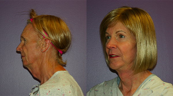 Facial Feminization before and after photo.