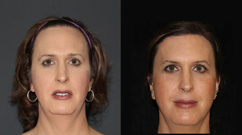 Facial Feminization before and after photo.