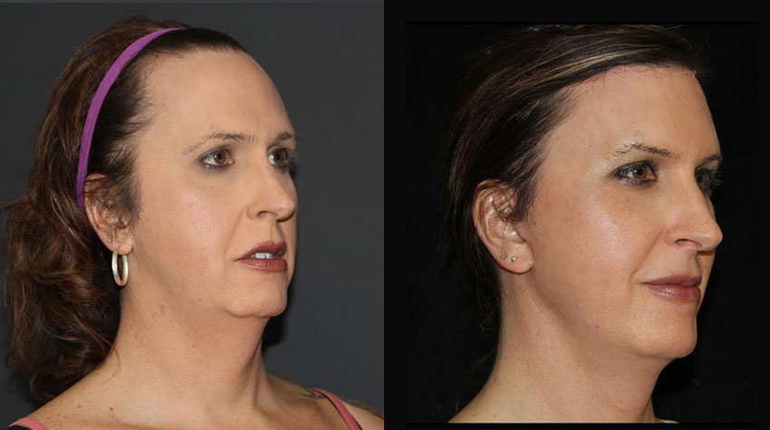Facial Feminization before and after photo.