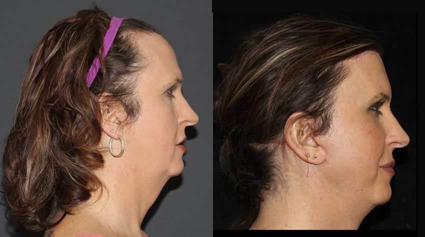 Facial Feminization before and after photo.